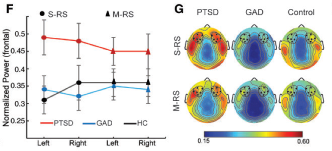 Searching for Signatures of PTSD in the EEG - Sapien Labs | Shaping the ...