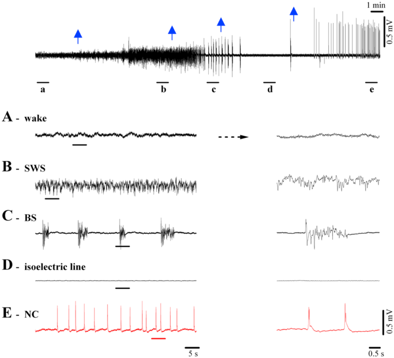 Dead or Alive? Rethinking the Flat Line EEG - Sapien Labs | Shaping the ...