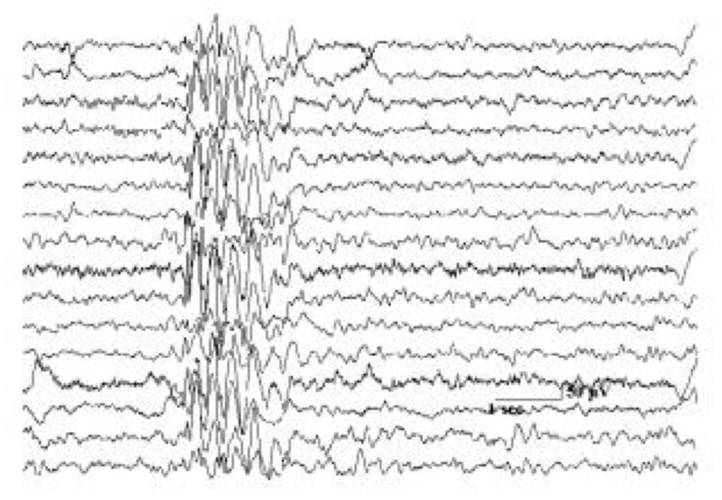 The Challenge of Seizure Prediction - Sapien Labs | Shaping the Future ...