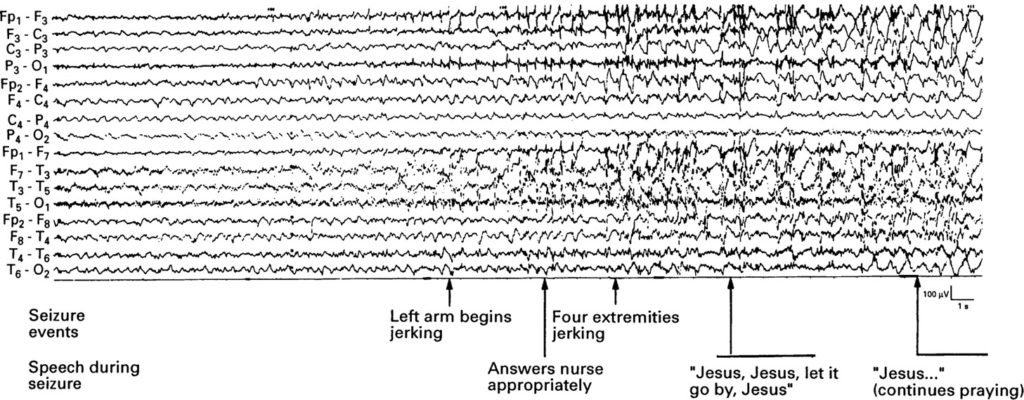 The Fundamental Challenge of Seizure Detection in the EEG - Sapien Labs ...